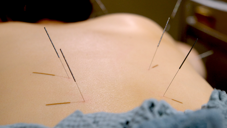 TCM for Polycystic Ovary Syndrome (PCOS)